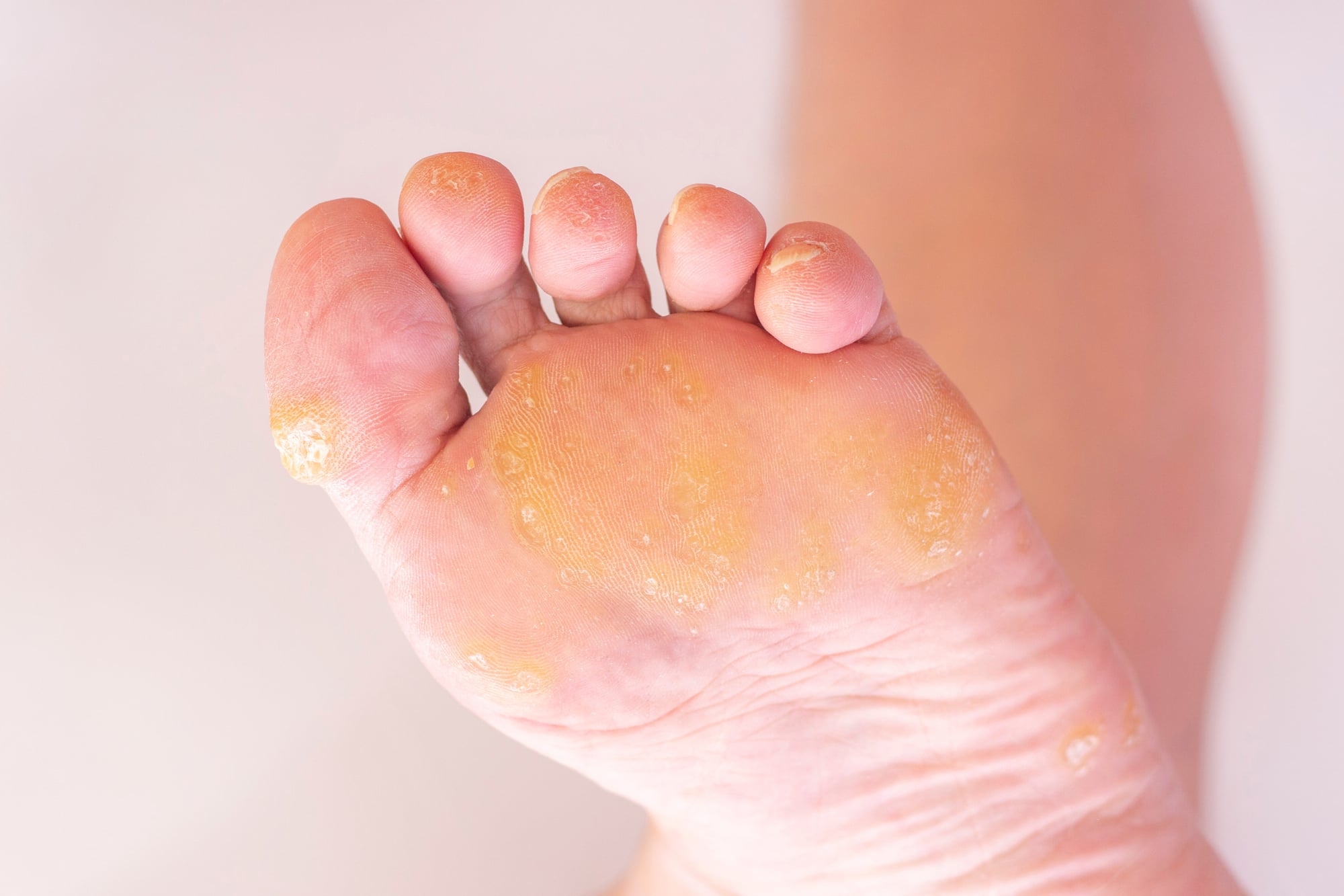 First Aid for Corns and Callouses - Foot Comfort Centre